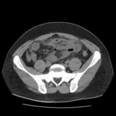 Backwash-Ileitis - DocCheck Flexikon
