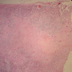 Nekrose - DocCheck Flexikon