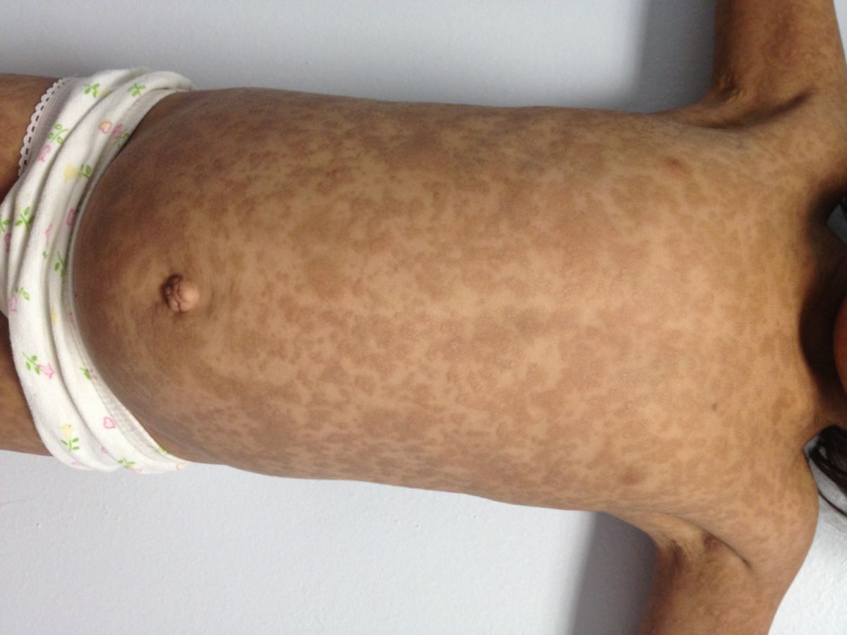 Mastozytose - DocCheck