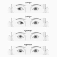 Exotropie - DocCheck Flexikon