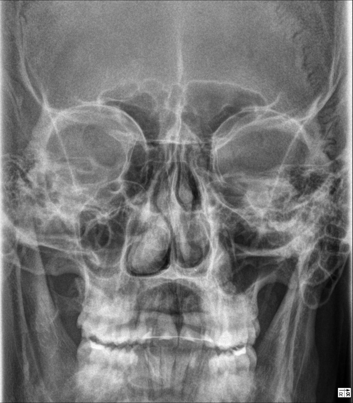 Paranasal sinuses - ap-projection - DocCheck