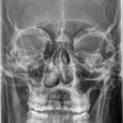 Nasennebenhöhlen - DocCheck Flexikon