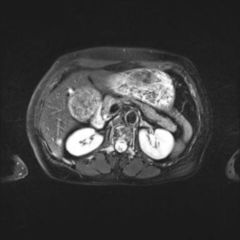 Drainage - DocCheck Flexikon