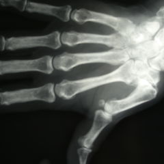 Rhizarthrose - DocCheck Flexikon