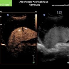 Milzruptur - DocCheck Flexikon