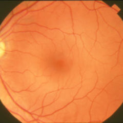 Arteria centralis retinae - DocCheck Flexikon