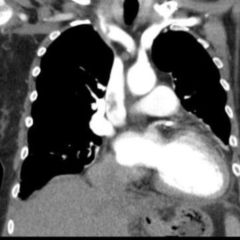 Fundoplikatio - DocCheck Flexikon