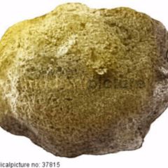 Nierenstein - DocCheck Flexikon