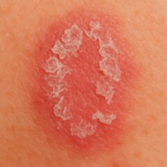 Hautschuppe - DocCheck Flexikon