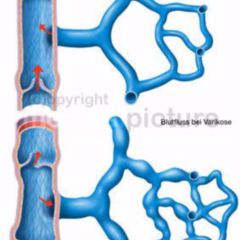 Varikosis - DocCheck Flexikon
