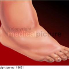 Charcot-Trias - DocCheck Flexikon
