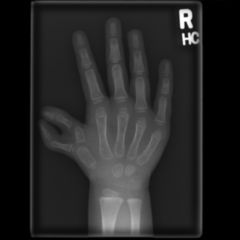 Polydaktylie - DocCheck Flexikon