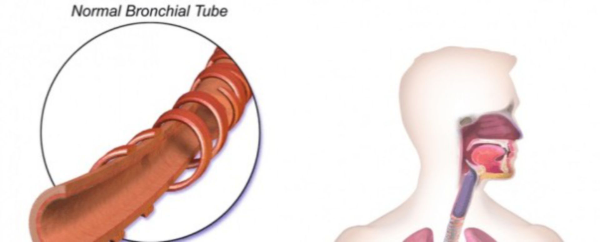Akute Bronchitis - DocCheck