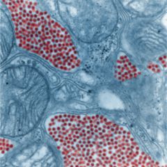 Limbische Enzephalitis - DocCheck Flexikon