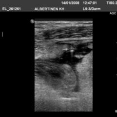 Epitheloidzellgranulom - DocCheck Flexikon