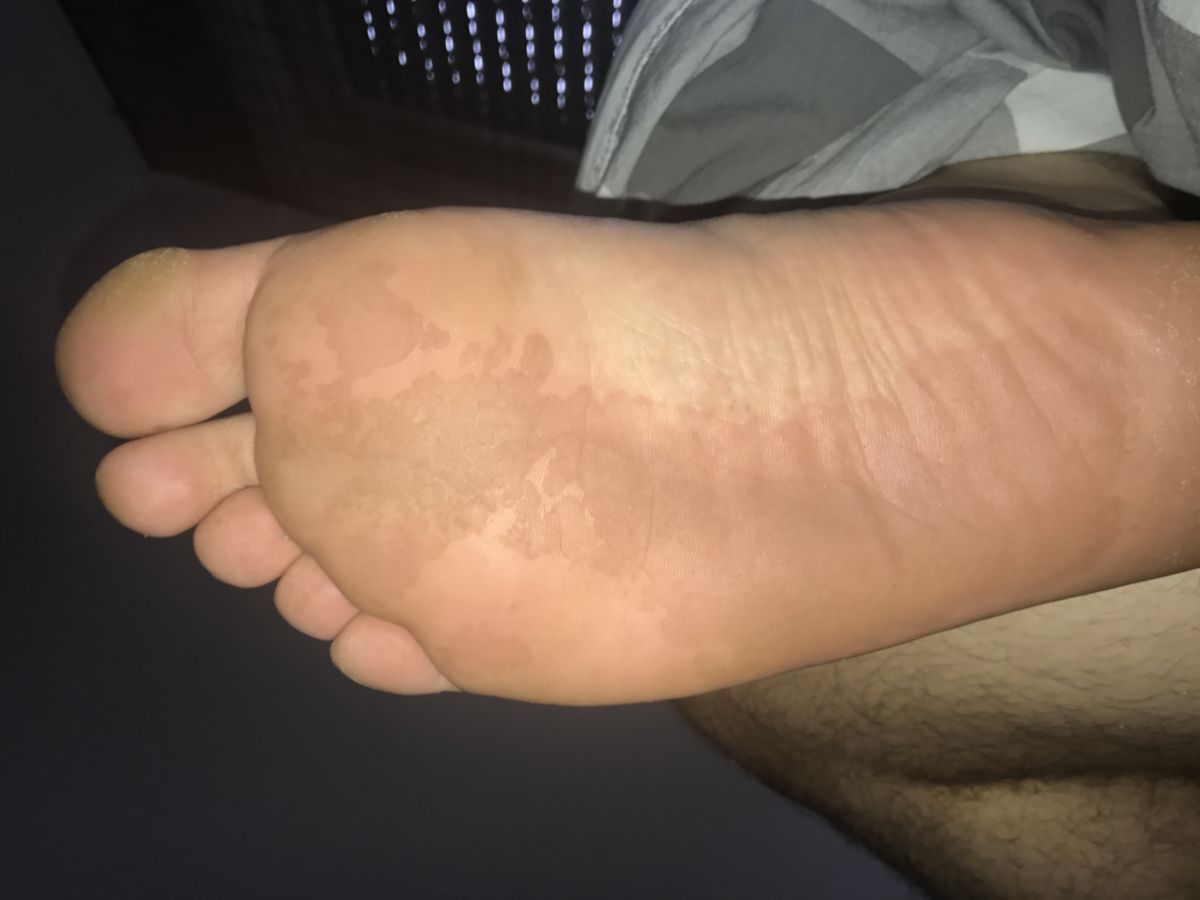 Hautveränderung Plantar - DocCheck