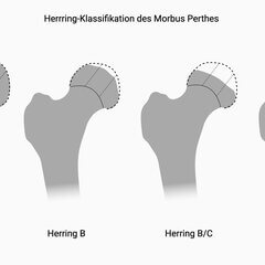 Morbus Perthes - DocCheck Flexikon