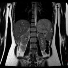 Situs inversus - DocCheck Flexikon