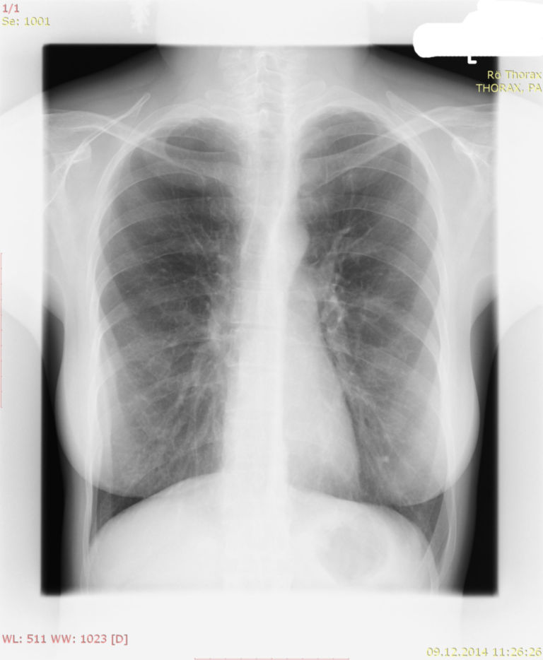 Röntgen Thorax 1 - DocCheck