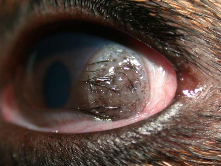 Corneal dermoid - DocCheck