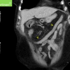 Colitis ulcerosa - DocCheck Flexikon