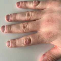 Dermatophagie - DocCheck Flexikon