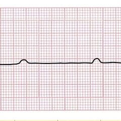 P-Wellen-Asystolie - DocCheck Flexikon
