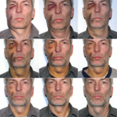 Hämatom - DocCheck Flexikon