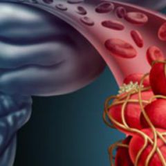 Thrombolyse - DocCheck Flexikon