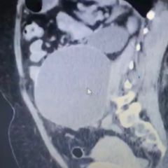 Lymphozele - DocCheck Flexikon