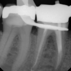 Pulpitis - DocCheck Flexikon