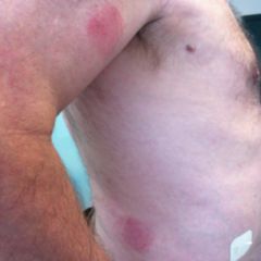 Blood-Patch - DocCheck Flexikon