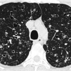 Bronchiolitis - DocCheck Flexikon