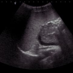 Milzhilus - DocCheck Flexikon