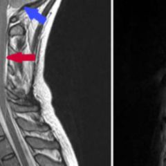Epiduralraum - DocCheck Flexikon