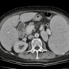 Splenomegalie - DocCheck Flexikon