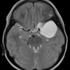 Subarachnoidalraum - DocCheck Flexikon