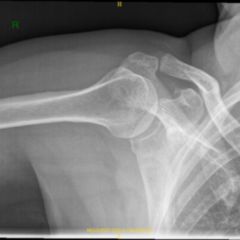 Schulter axial - DocCheck Flexikon