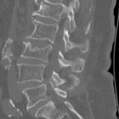 Impressionsfraktur - DocCheck Flexikon