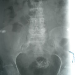 Spondylolisthesis - DocCheck Flexikon