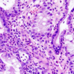 Zervixkarzinom - DocCheck Flexikon