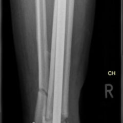 Distale Tibiafraktur - DocCheck Flexikon