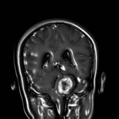 Porus acusticus internus - DocCheck Flexikon