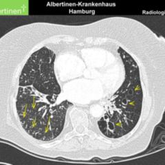 Infiltrat - DocCheck Flexikon