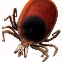 Lyme-Borreliose - DocCheck Flexikon