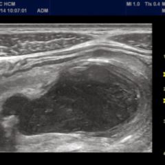 Appendix vermiformis - DocCheck Flexikon