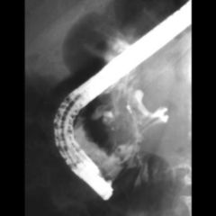 Intraduktale papillär-muzinöse Neoplasie - DocCheck Flexikon