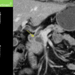 Intraduktale papillär-muzinöse Neoplasie - DocCheck Flexikon
