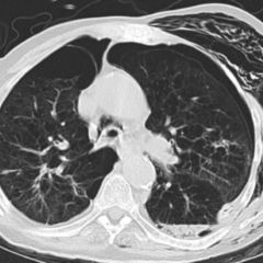 Subkutane Infusion - DocCheck Flexikon
