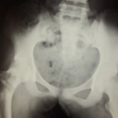 Osteom - DocCheck Flexikon